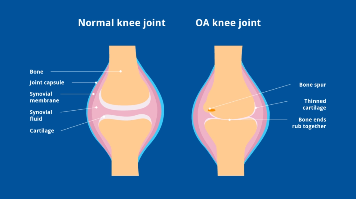 What is osteoarthritis?