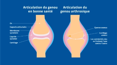 Qu’est-ce que l’arthrose?